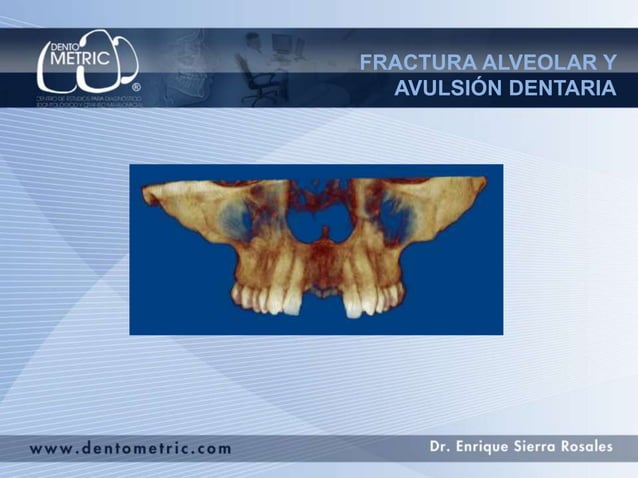 Fractura alveolar y avulsion dentaria, | PPTX | Medical Health