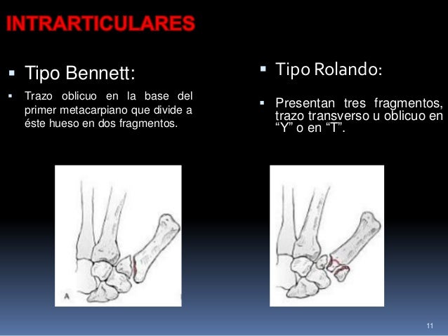 Fractura bennett rolando
