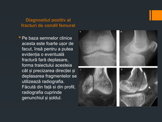 fractura condil-prezentare ppt despre.pptx