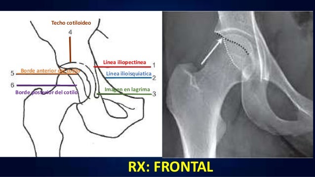 Fractura de acetabulo Adry Teran