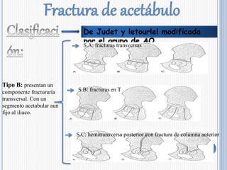 Fractura de acetabulo | PPTX