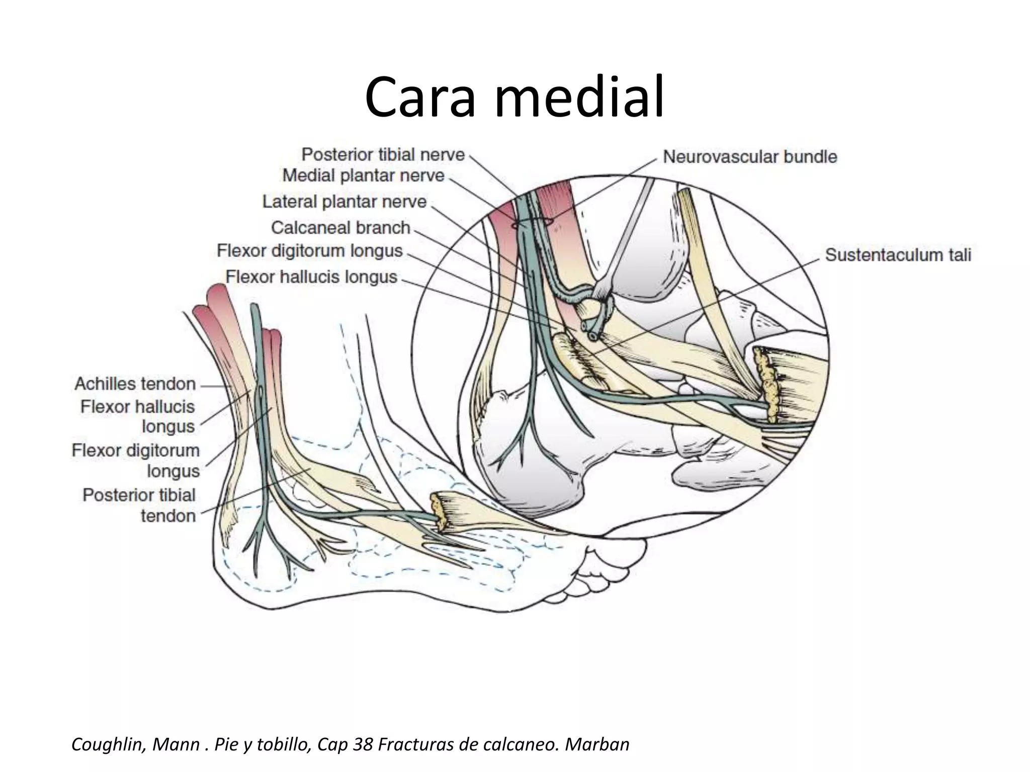 Fractura de calcaneo | PPTX