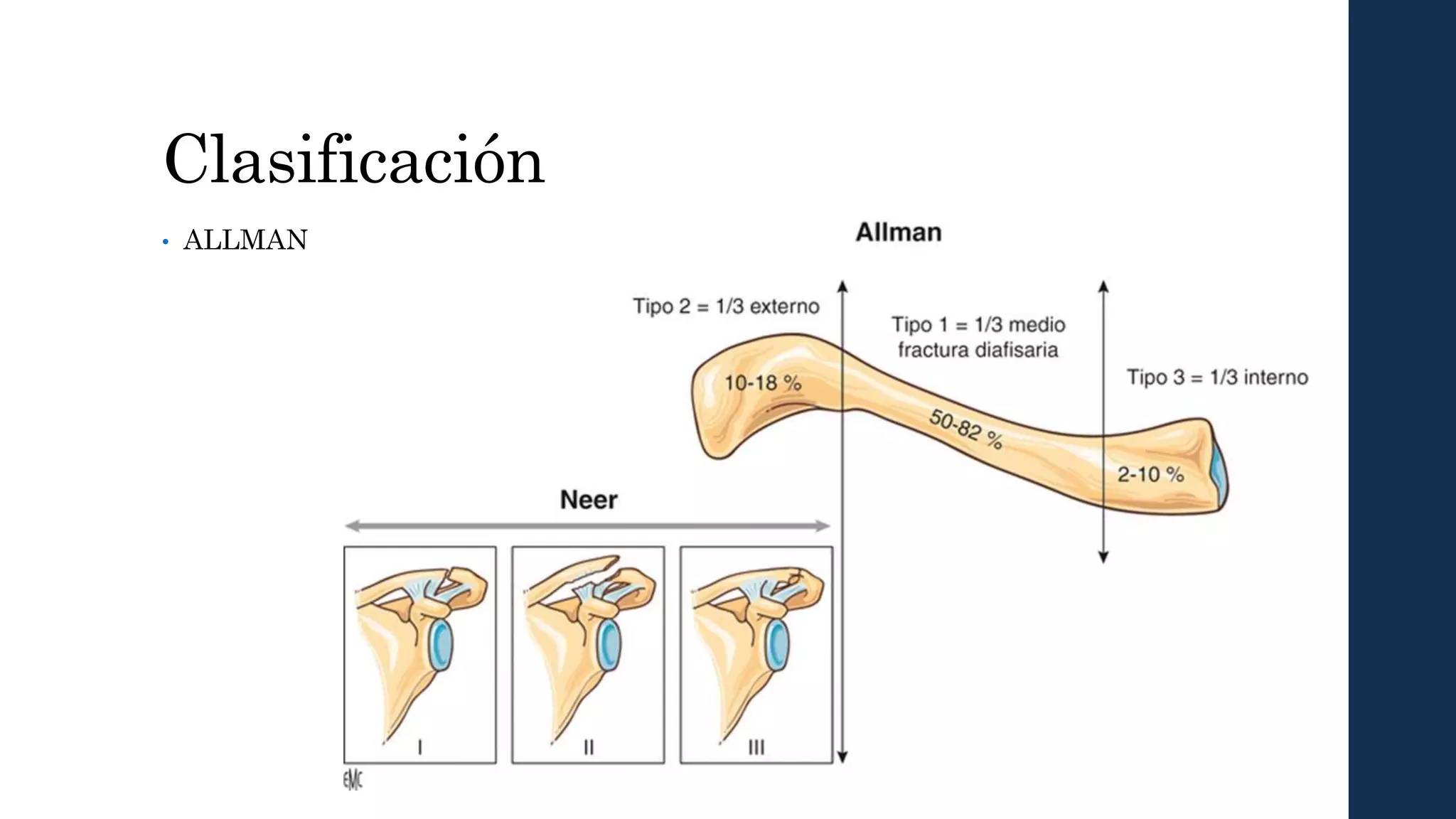 Fractura de clavícula.pptx