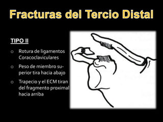 Fractura de clavícula y escápula | PPTX