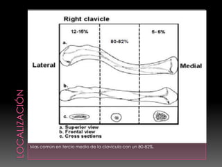 Fractura de clavicula | PPTX