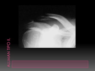 Fractura de clavicula | PPTX