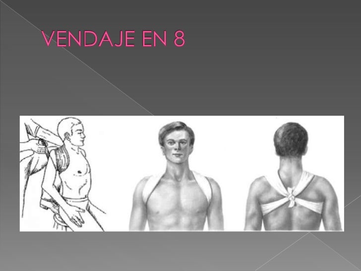 Fractura De Clavicula Fractura De Clavicula