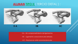 Fracturas de clavicula | PPTX