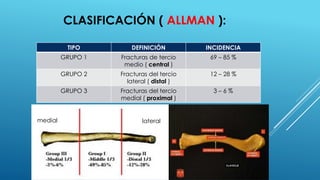 Fracturas de clavicula | PPTX