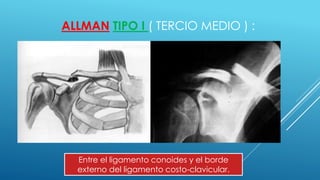 Fracturas de clavicula | PPTX