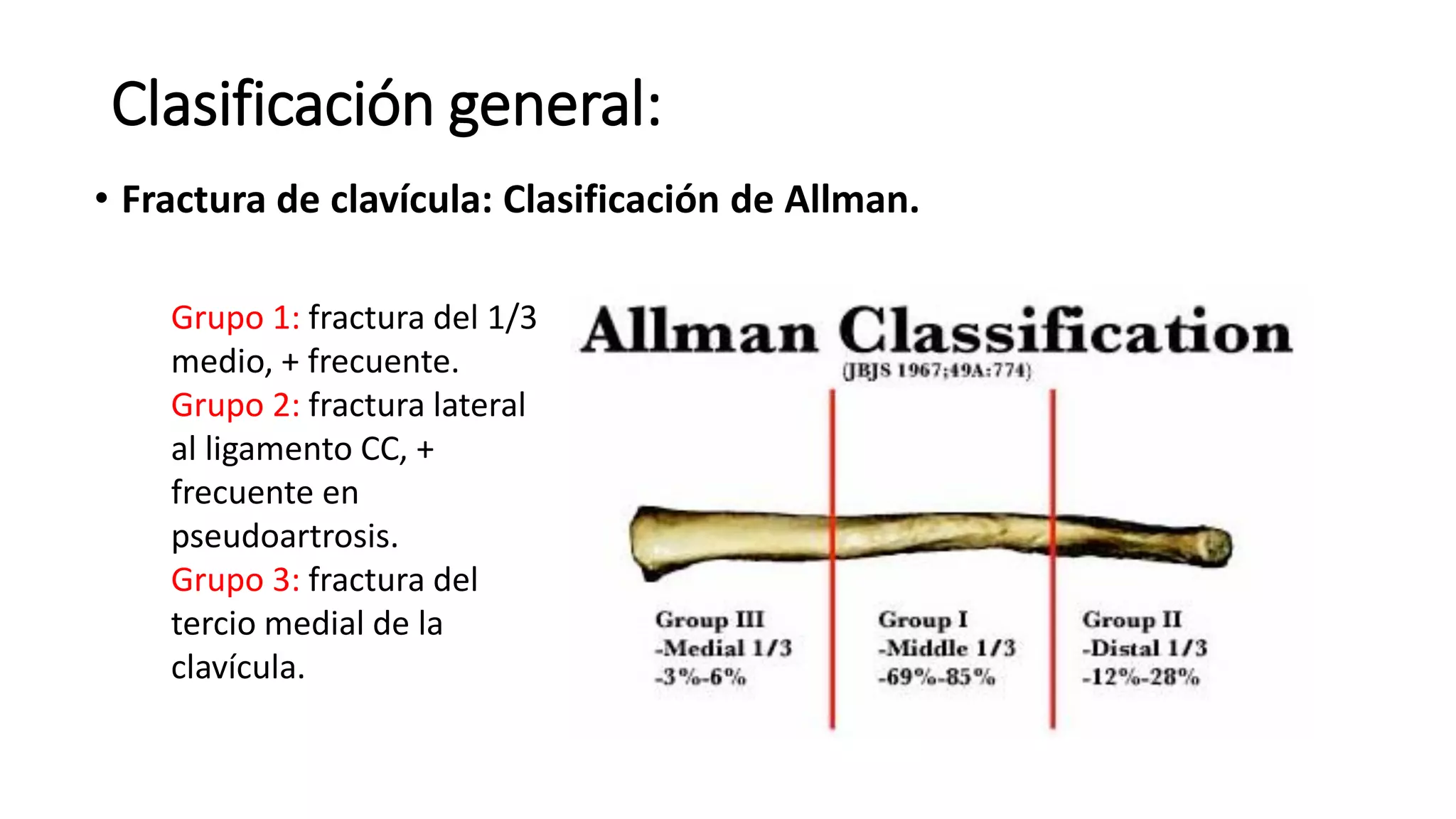 Fractura de clavícula .pdf