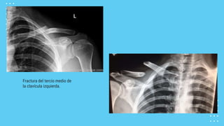 Fractura de Clavicula.pptx