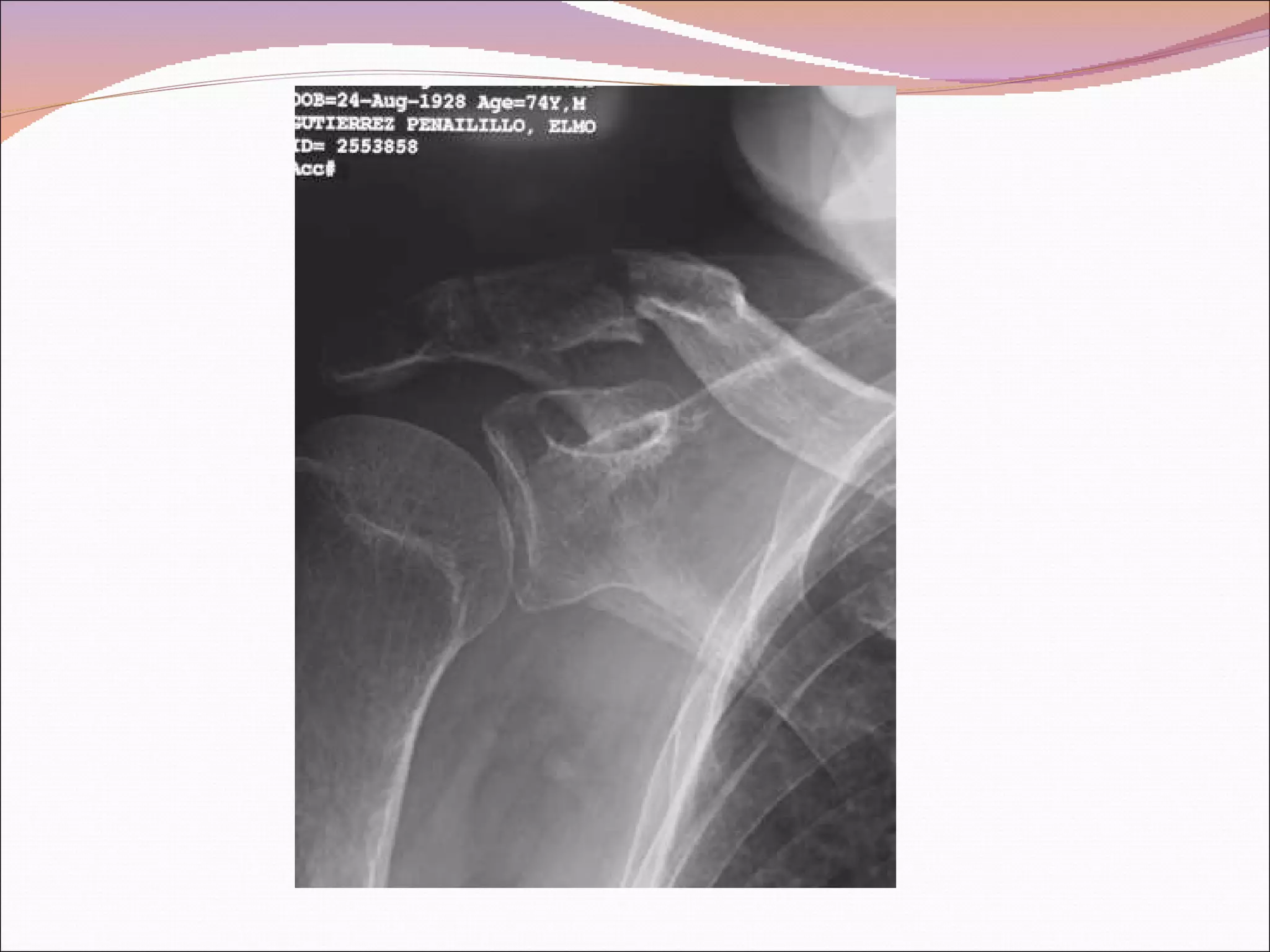 Fractura De Clavicula Y Escapula Por Adriana Moncayo | PPT