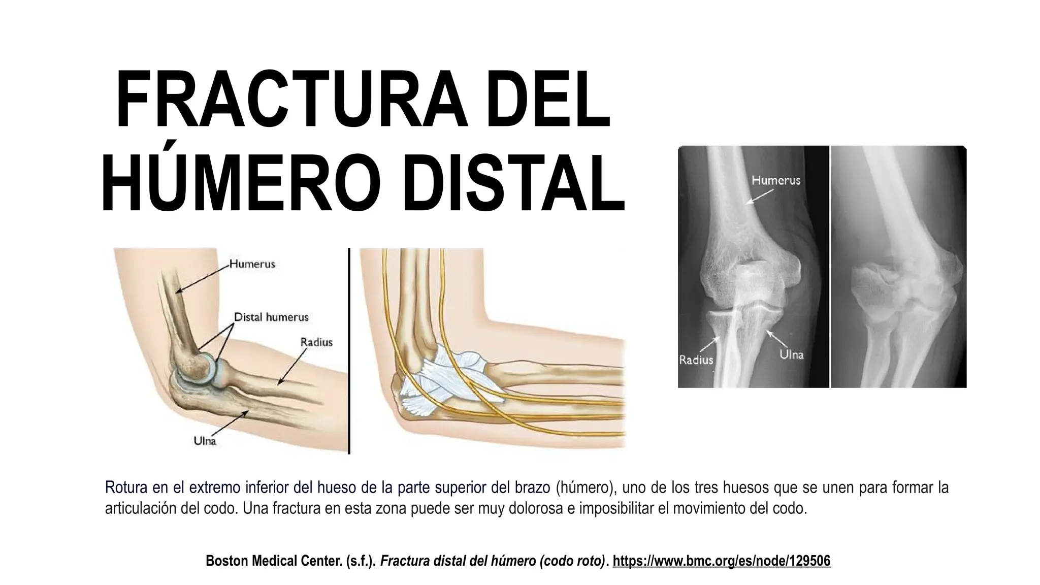 luxofractura de codo tipos de fracturas del humero distal.pptx