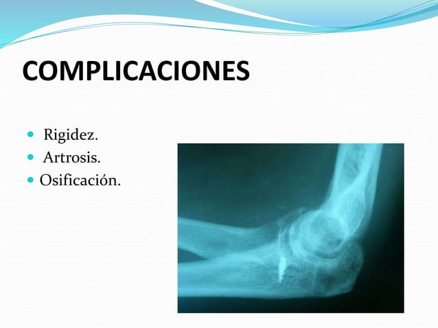 Fractura de codo | PPTX