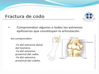 Fractura de codo | PPTX