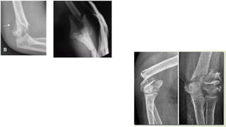 FRACTURA DE CODO | PPTX