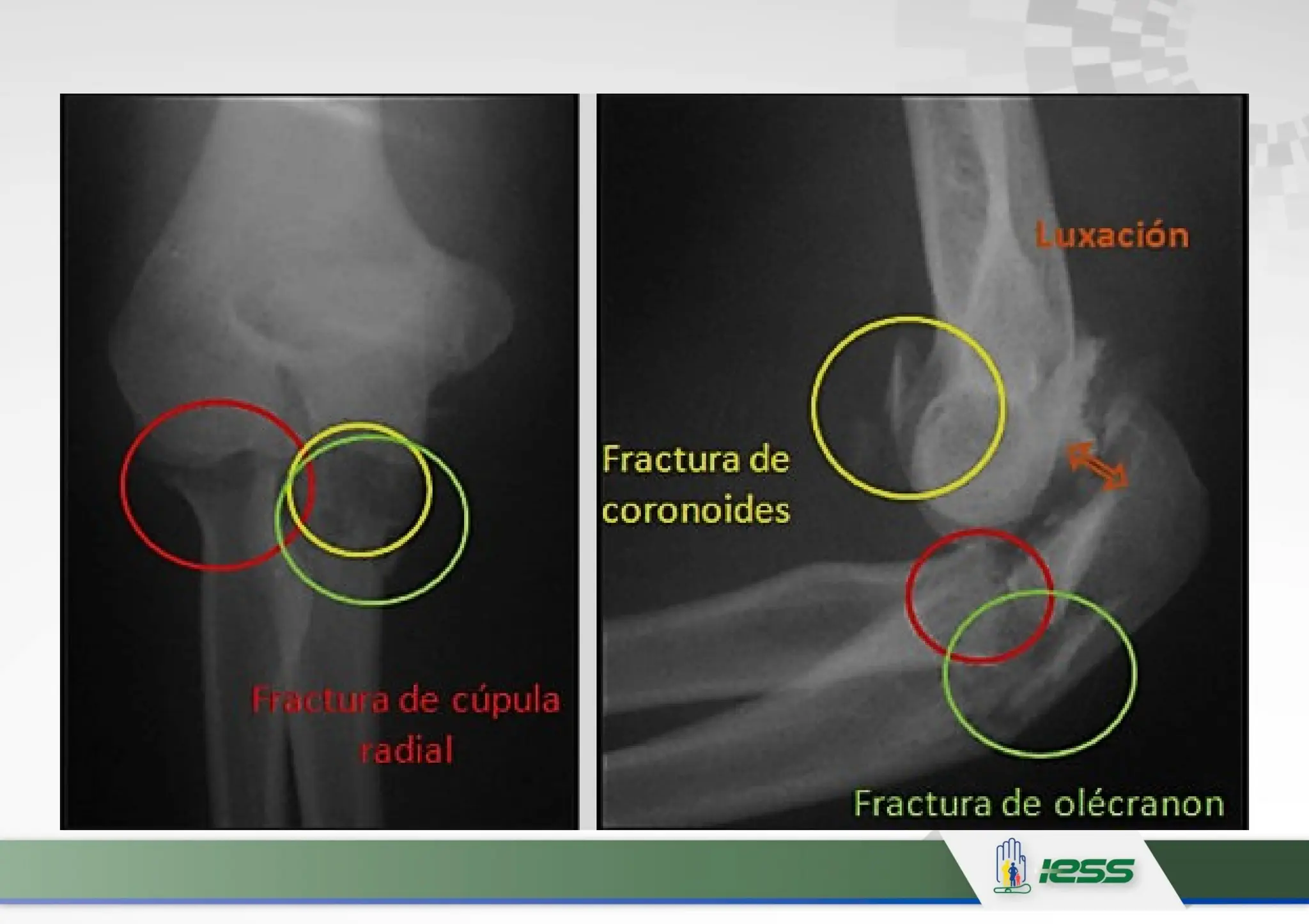 FRACTURA DE CODO T TRIADA DE CODO TERRIBLE.pptx