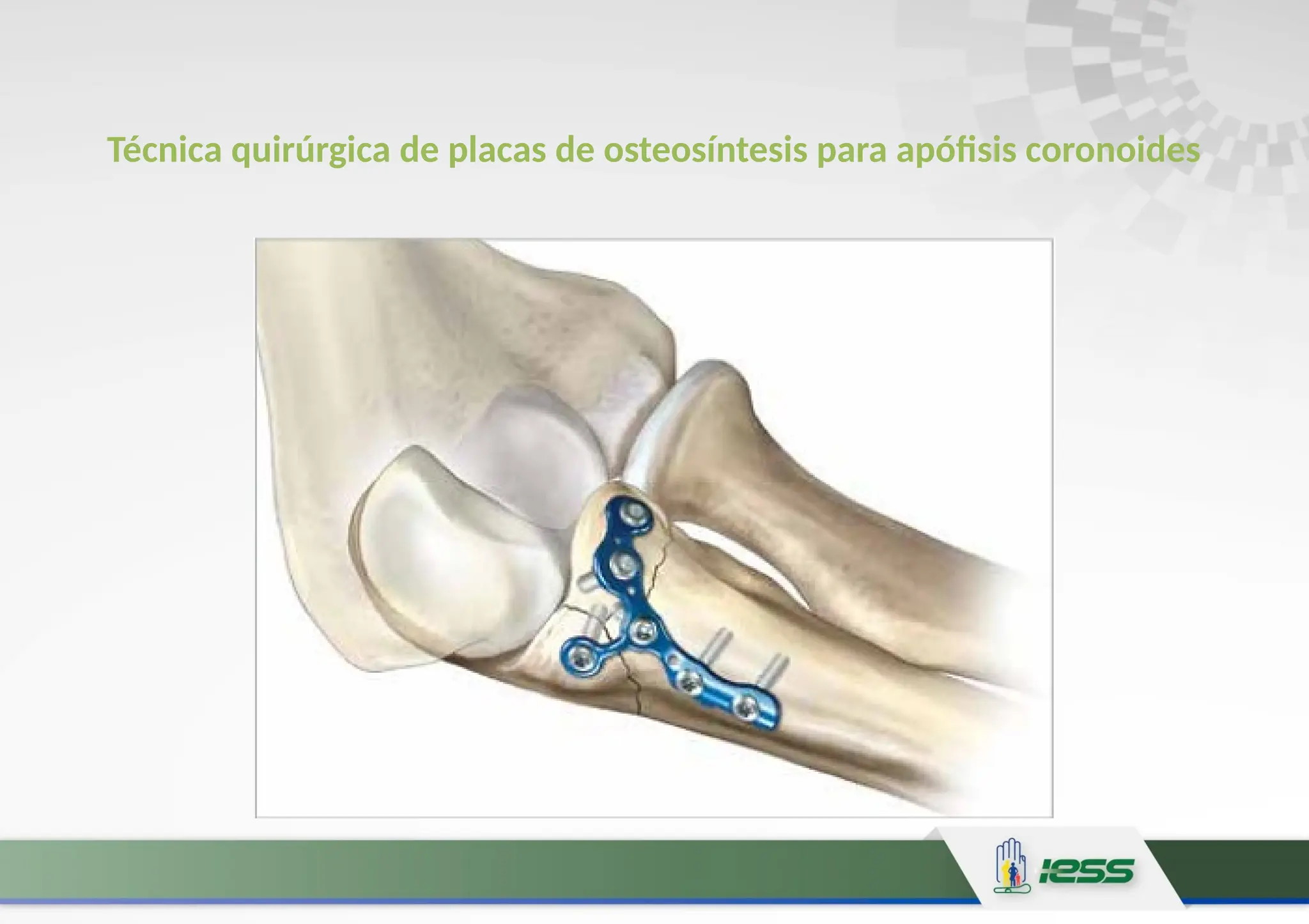 FRACTURA DE CODO T TRIADA DE CODO TERRIBLE.pptx