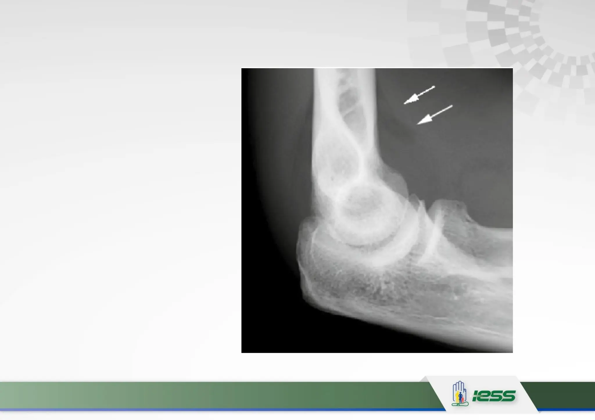 FRACTURA DE CODO T TRIADA DE CODO TERRIBLE.pptx