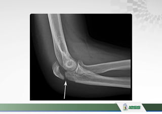 FRACTURA DE CODO T TRIADA DE CODO TERRIBLE.pptx
