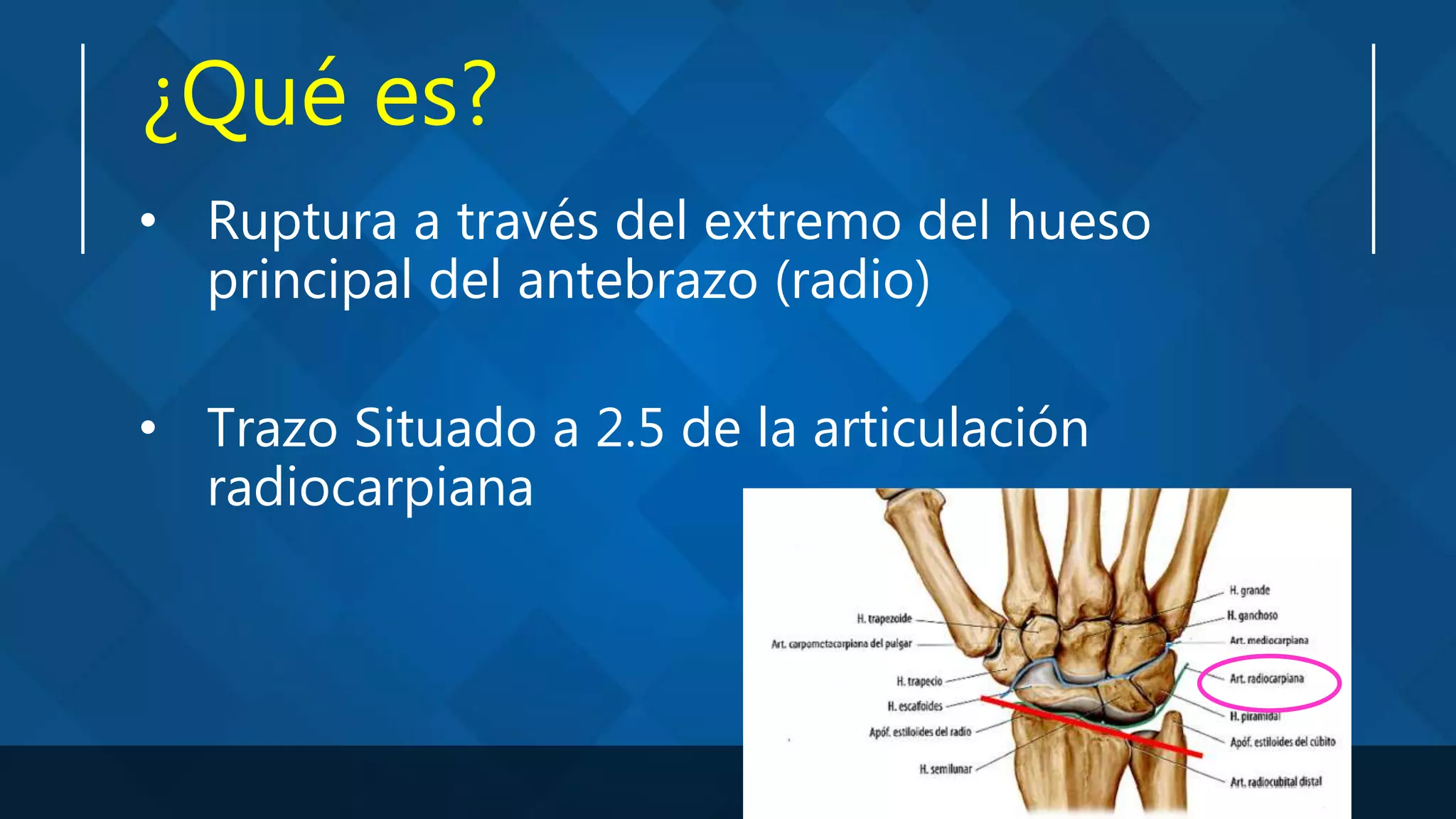 Fractura de colles y smith | PPTX