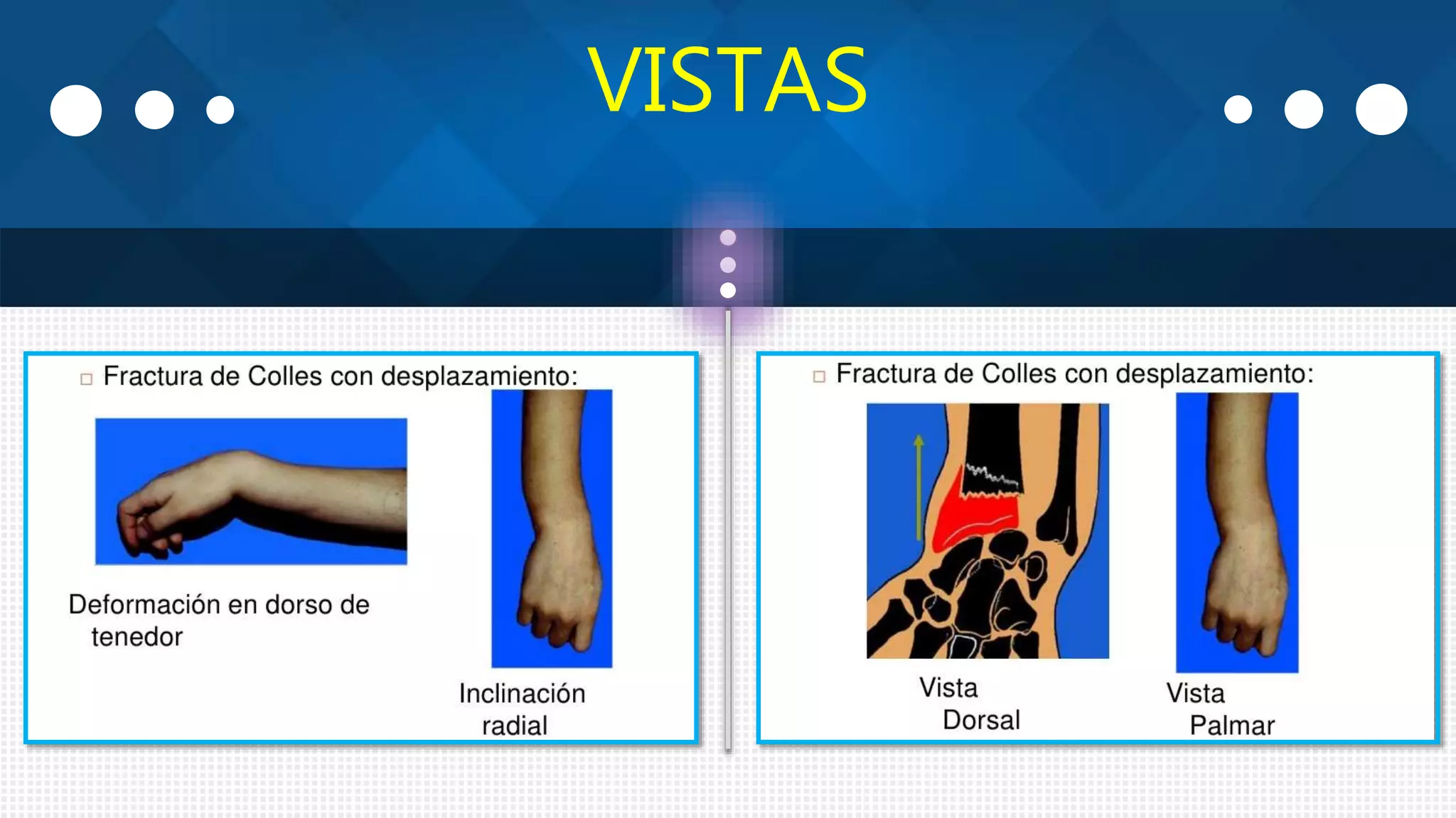 Fractura de colles y smith | PPTX