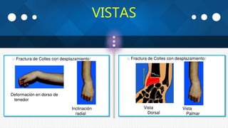 Fractura de colles y smith | PPTX