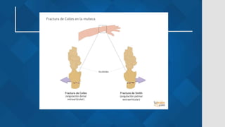 Fractura de colles y smith | PPTX