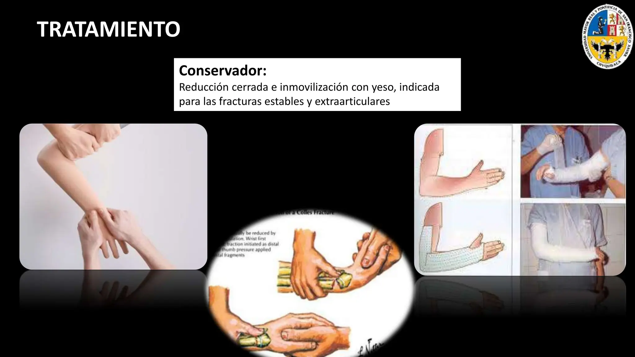 fractura de colles traumatologia, muñeca | PPT