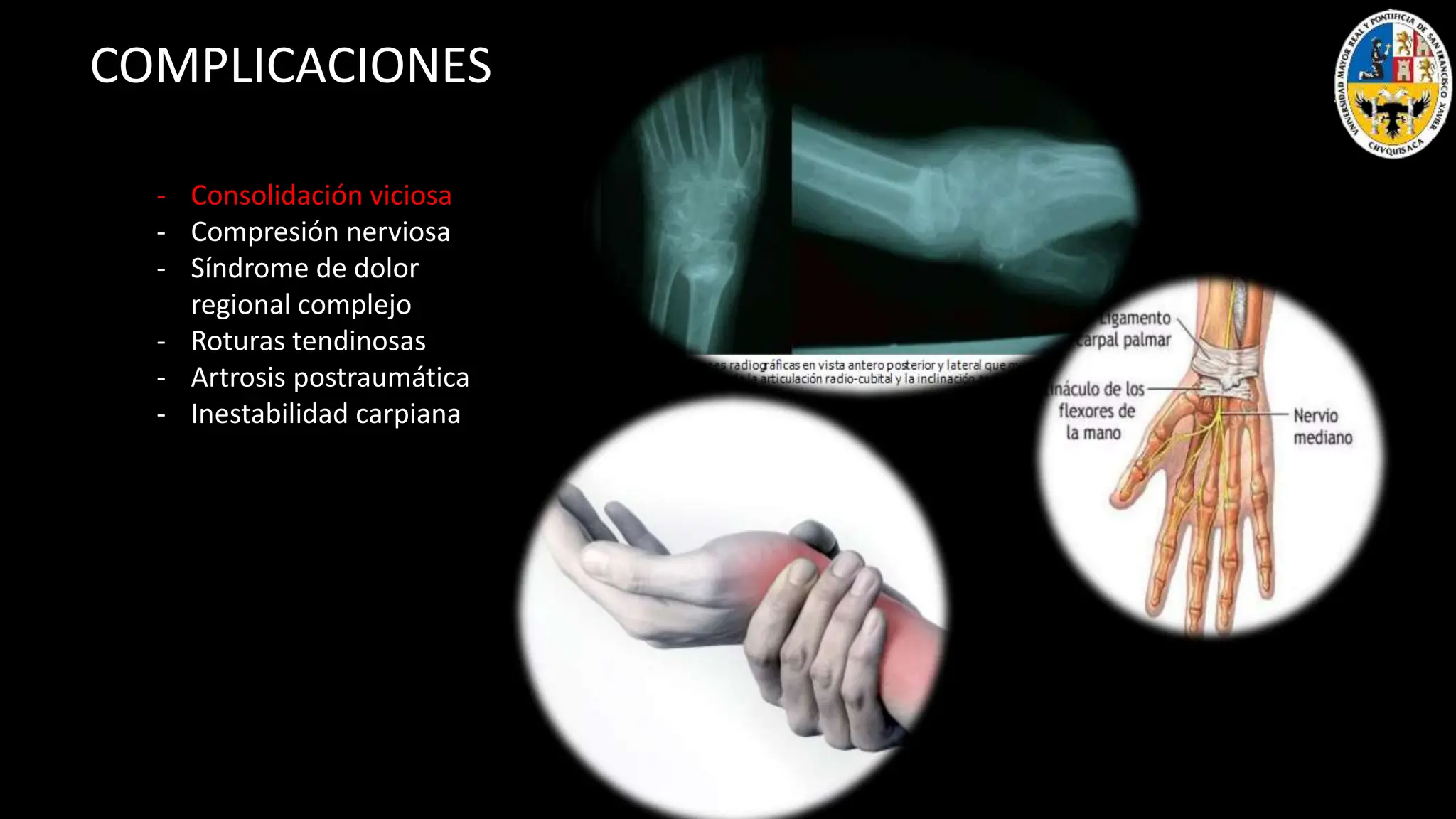 fractura de colles traumatologia, muñeca | PPT