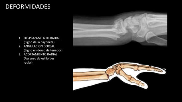 fractura de colles traumatologia, muñeca | PPT