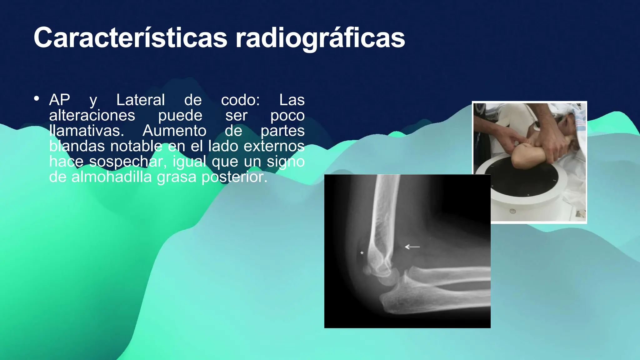 FRACTURA DE CONDILO PEDIATRICO ORTOPEDIATRIA | PPT