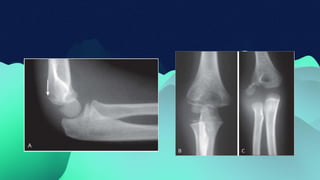 FRACTURA DE CONDILO PEDIATRICO ORTOPEDIATRIA | PPTX