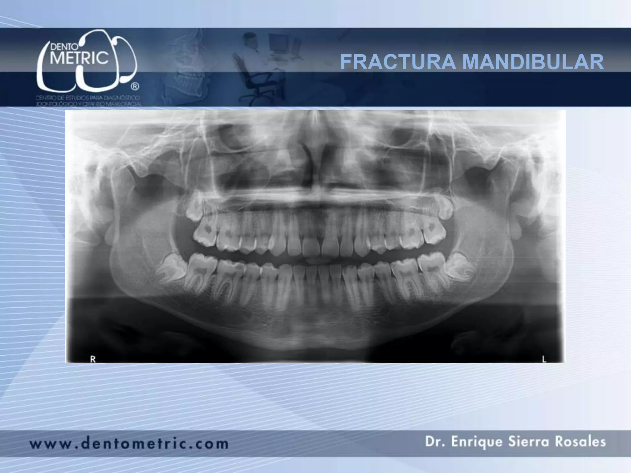 Fractura de condilo y angulo mandibular, | PPTX