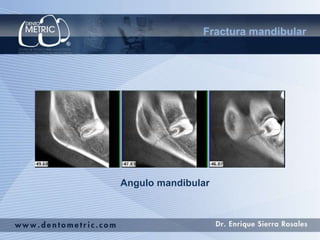 Fractura de condilo y angulo mandibular, | PPTX
