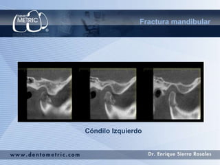 Fractura de condilo y angulo mandibular, | PPTX