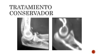 Fractura de coronoide.pptx
