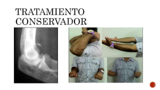 Fractura de coronoide.pptx