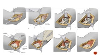 Fractura de coronoide.pptx