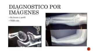 Fractura de coronoide.pptx