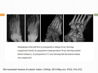 Fractura de cuboides y calcáneo | PPTX