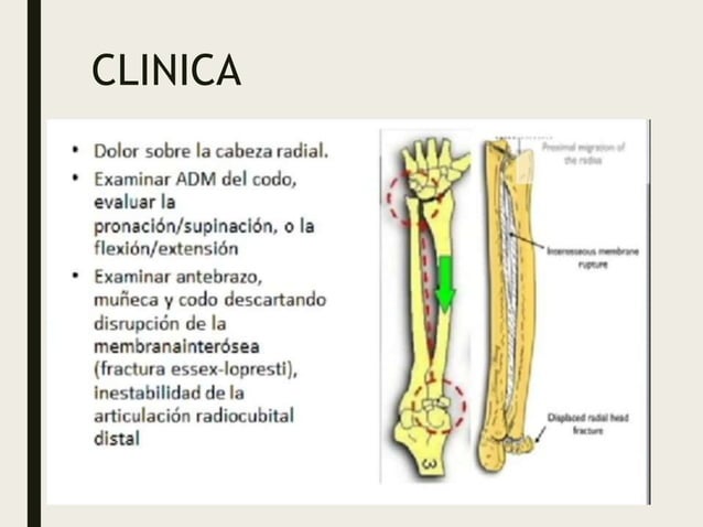 Fractura de cupula radial .pptx