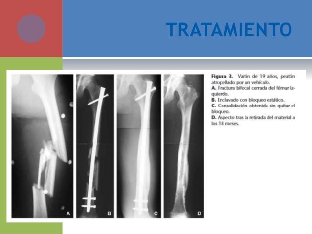 Fractura de diafisis femoral