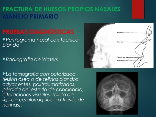 Fractura De Huesos Nasales Dr Omar Gonzales Suazo