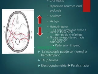 FRACTURA DE HUESO TEMPORAL - DR. OMAR GONZALES SUAZO. | PPT