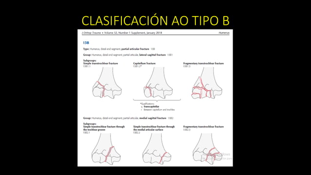 FRACTURA DE HUMERO DISTAL se comenta los tipos de fractura de humero ...