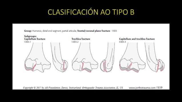 FRACTURA DE HUMERO DISTAL se comenta los tipos de fractura de humero ...