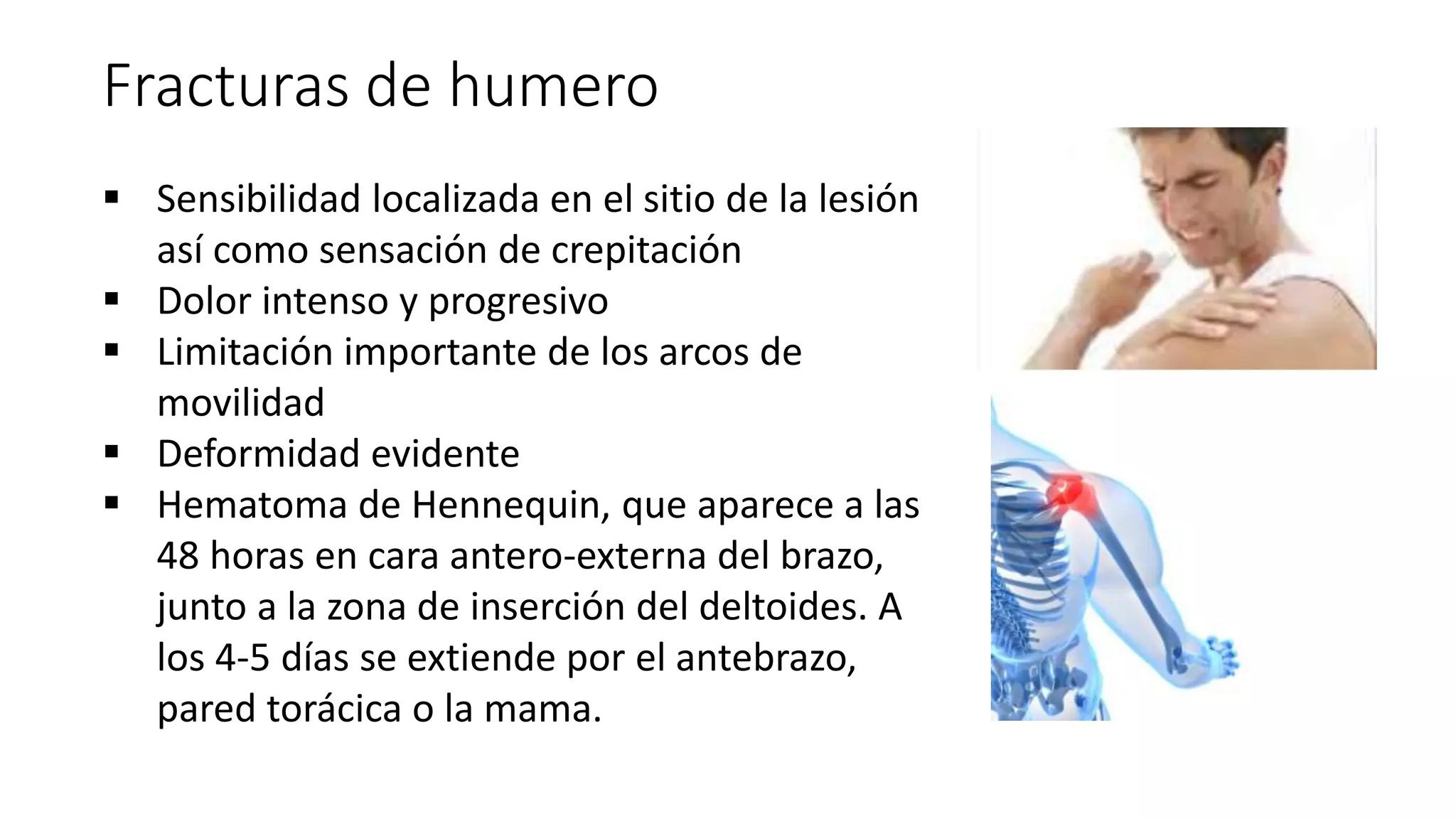 Fractura de la cabeza humeral | PPTX