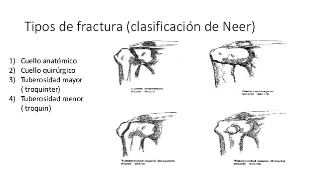 Fractura de la cabeza humeral